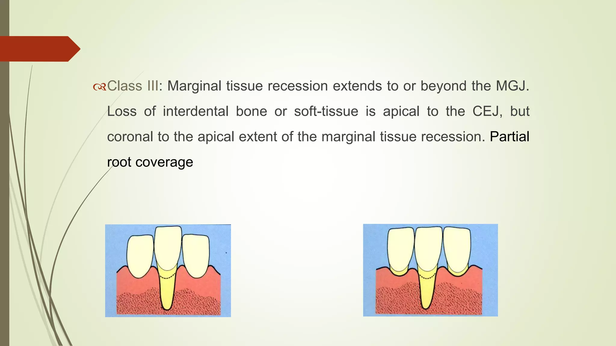 5.gingival recession seminar | PPTX