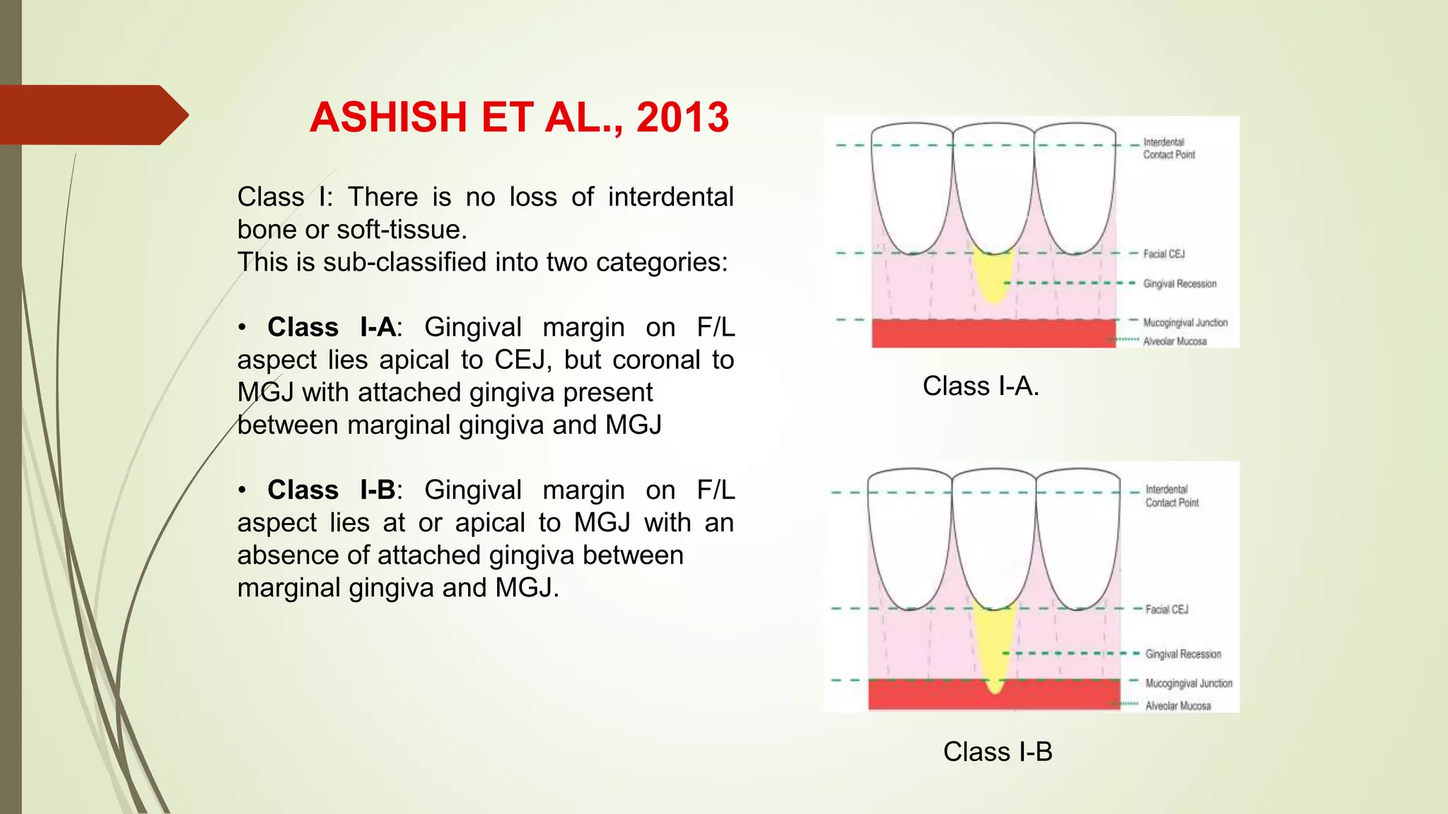 5.gingival recession seminar | PPTX