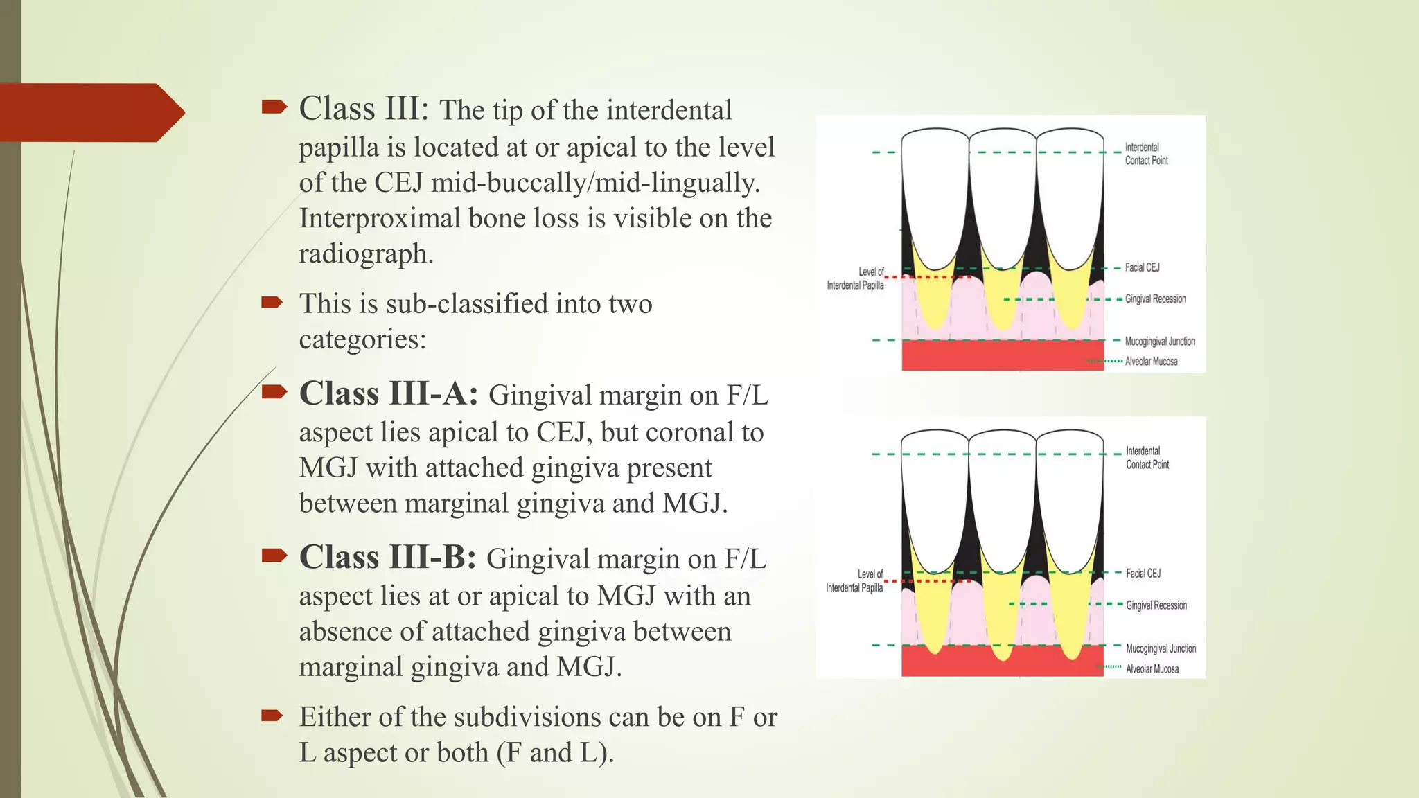 5.gingival recession seminar | PPTX