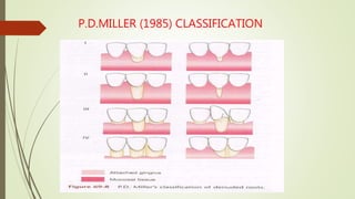 Gingival Recession Classification
