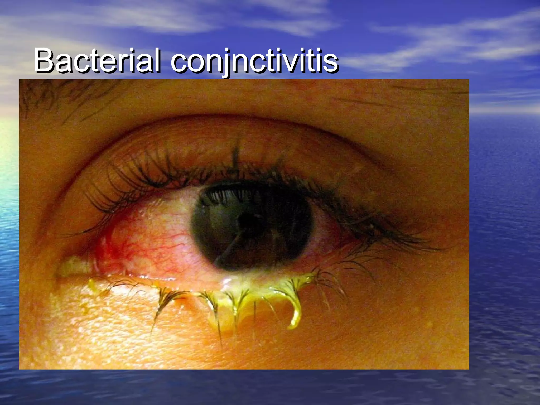 Red eye conjunctivitis | PPT