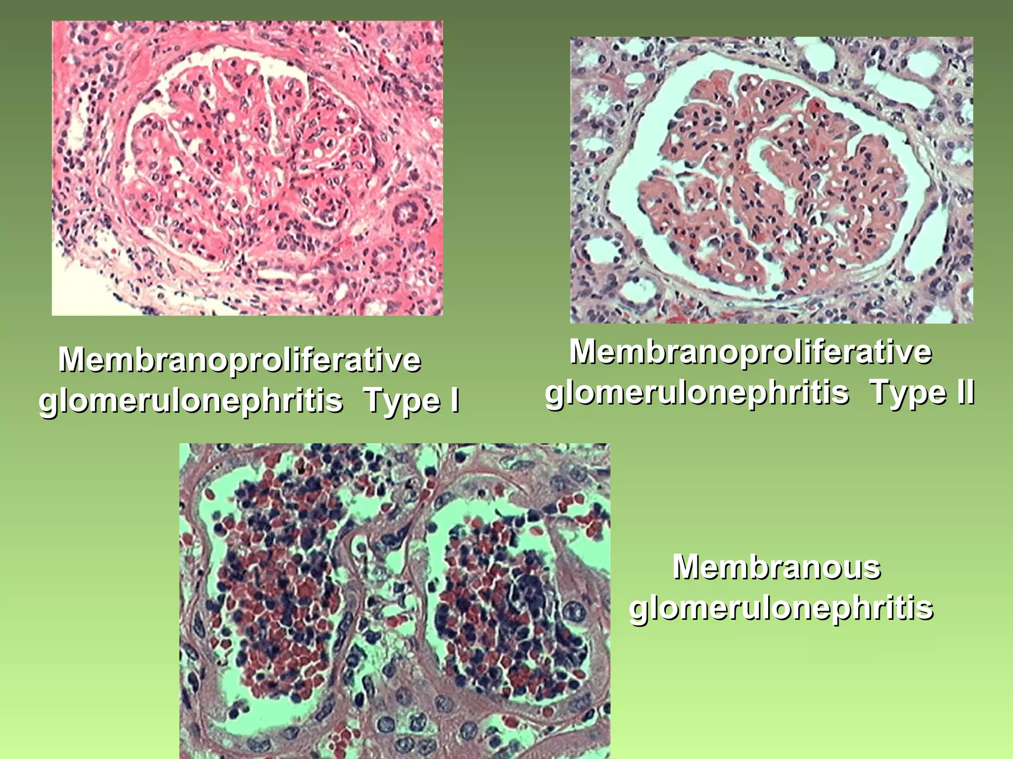 Glomerulonephritis in children | PPT