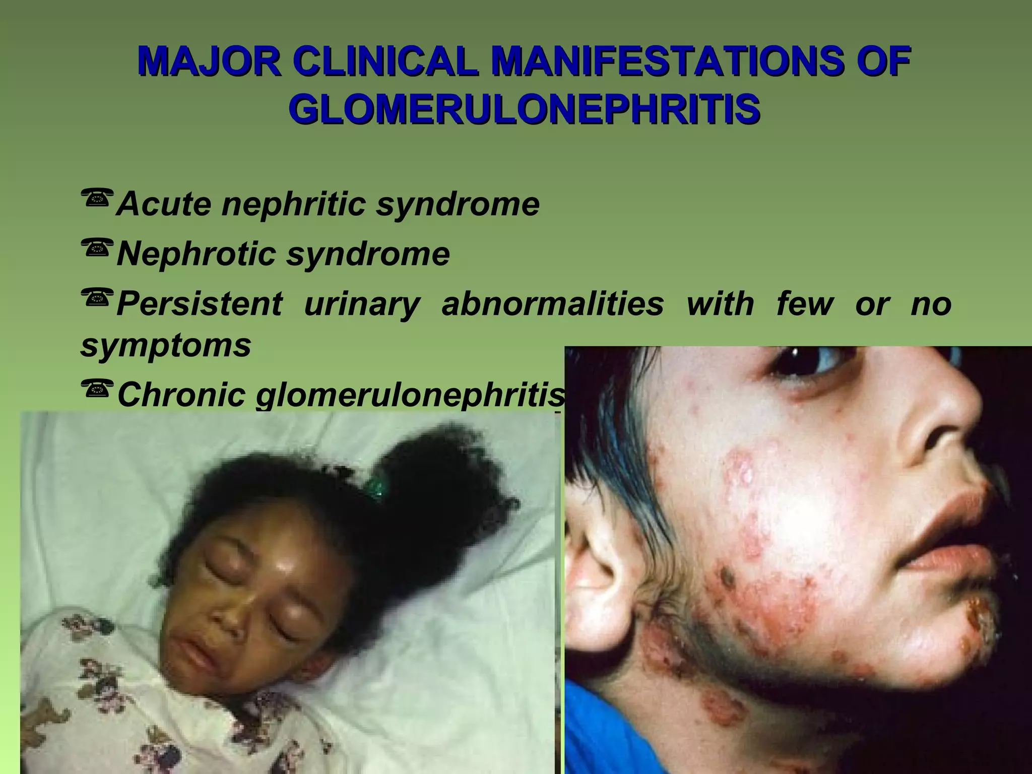 Glomerulonephritis in children | PPT