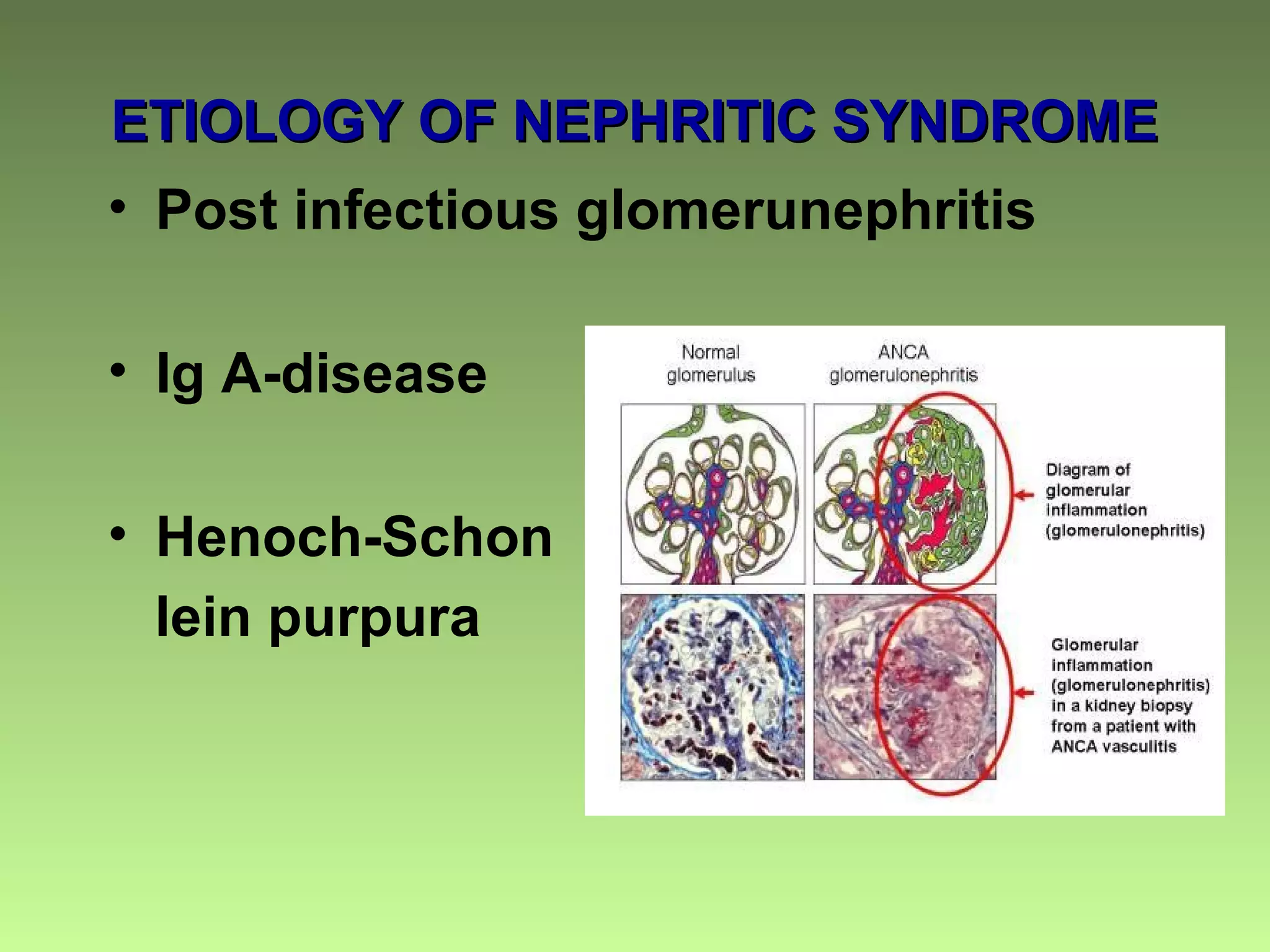 Glomerulonephritis in children | PPT
