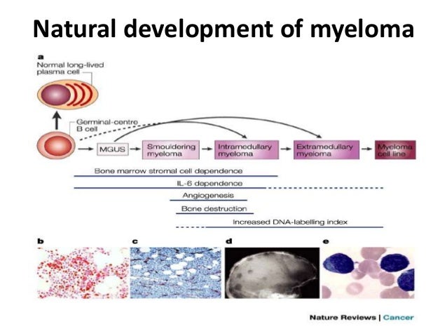Multiple Myeloma