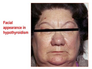 Thyroid and Anti-Thyroid hormones | PPT