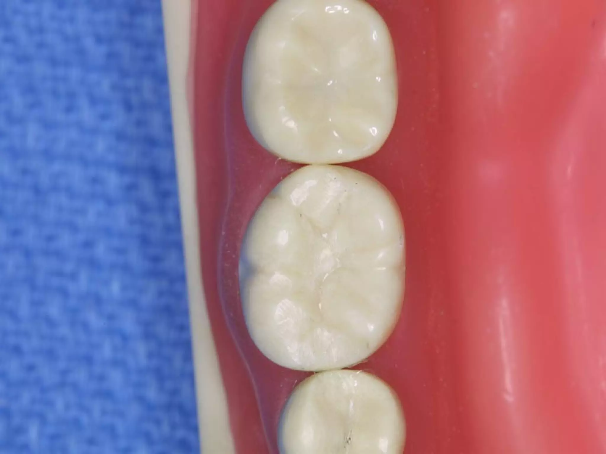 5.full metal crown | PPT