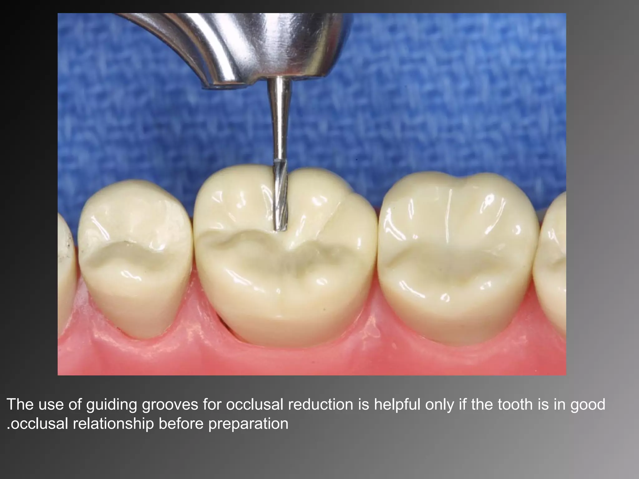 5.full metal crown | PPT