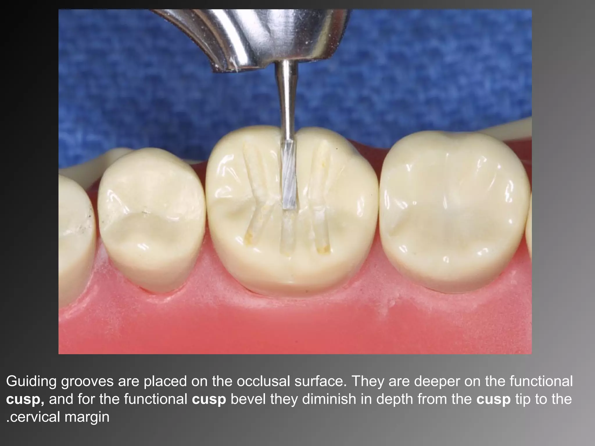 5.full metal crown | PPT