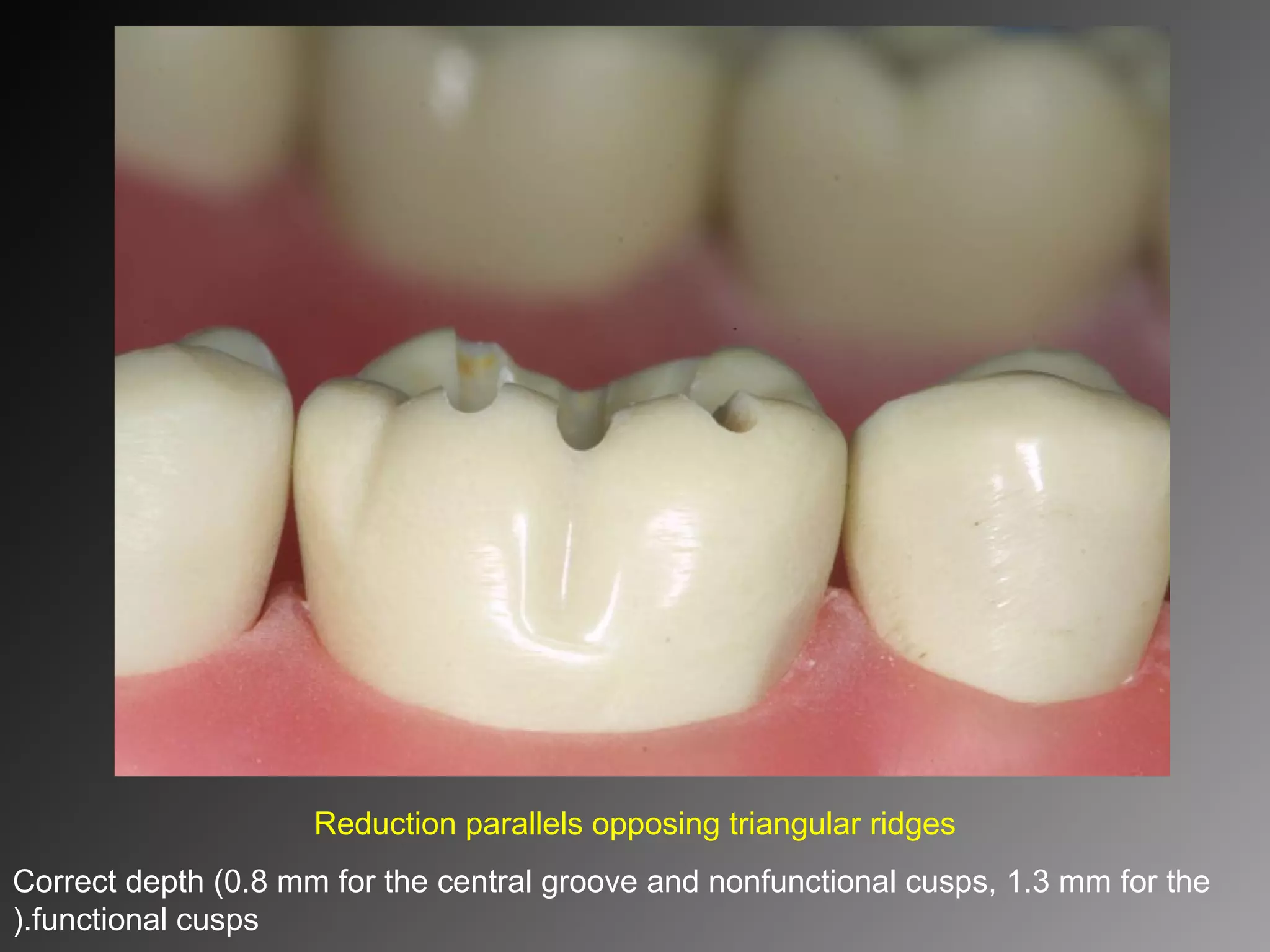 5.full metal crown | PPT