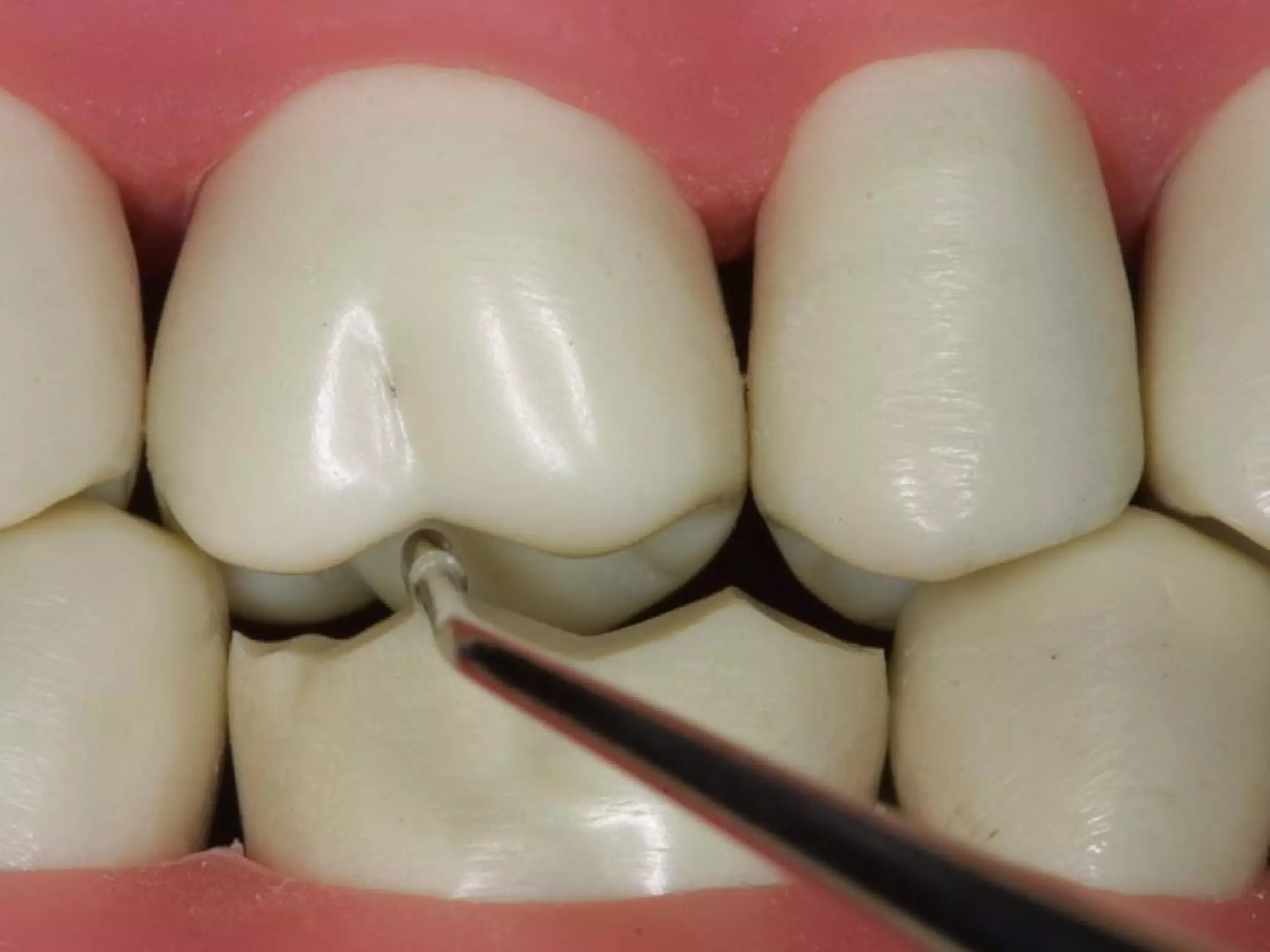 5.full metal crown | PPT