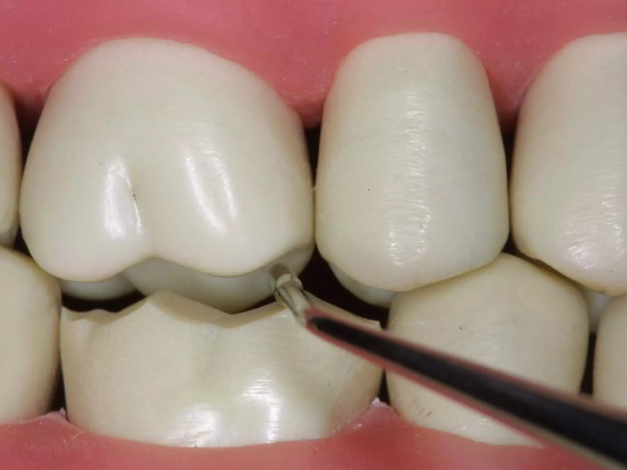 5.full metal crown | PPT