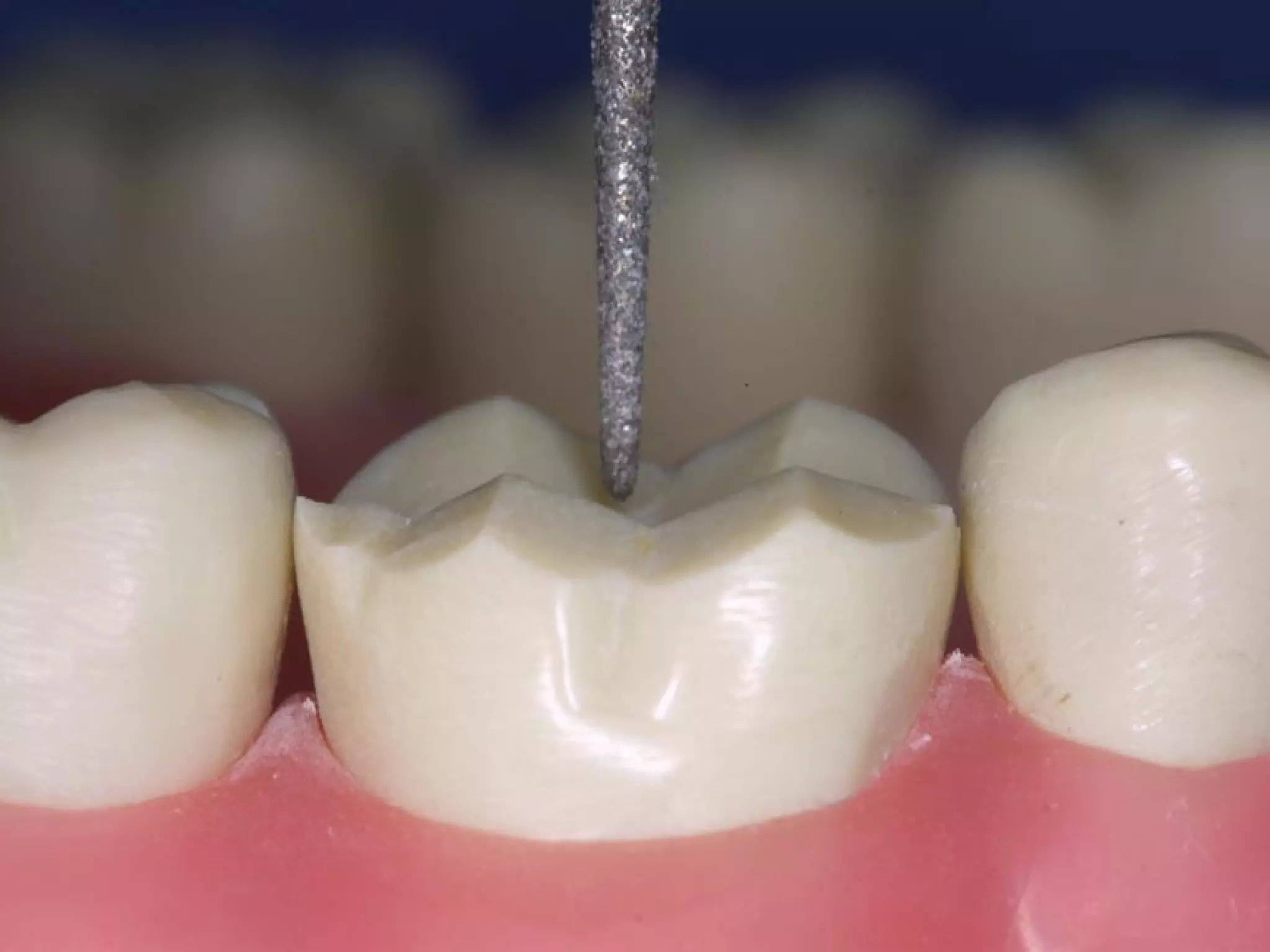 5.full metal crown | PPT