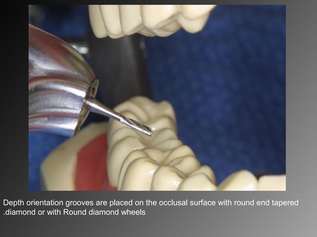 5.full metal crown | PPT