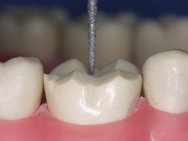 5.full metal crown | PPT