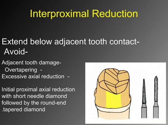 5.full metal crown | PPT