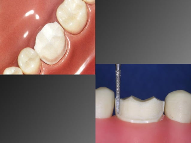 5.full metal crown | PPT