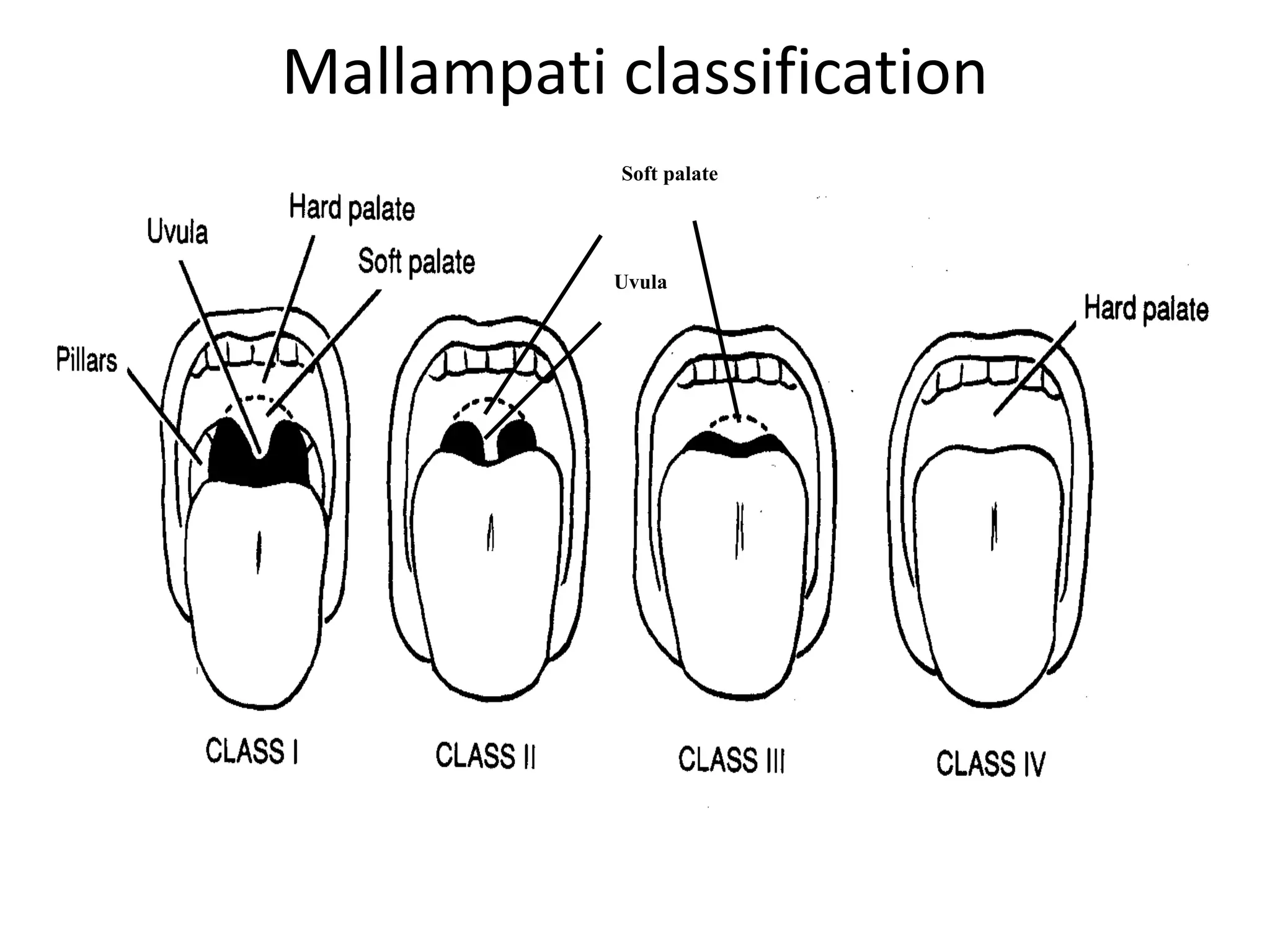 Endotracheal intubation in oral & maxillofacial surgery | PPTX