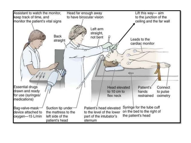 Endotracheal intubation in oral & maxillofacial surgery | PPTX | Ear ...