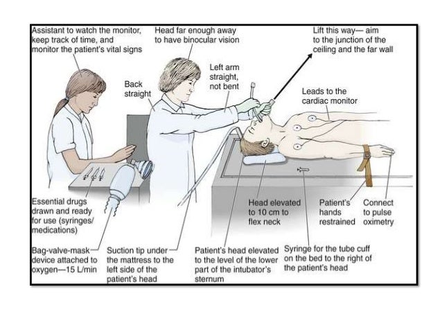 Endotracheal intubation in oral & maxillofacial surgery