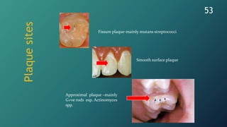 Dental caries | PPTX