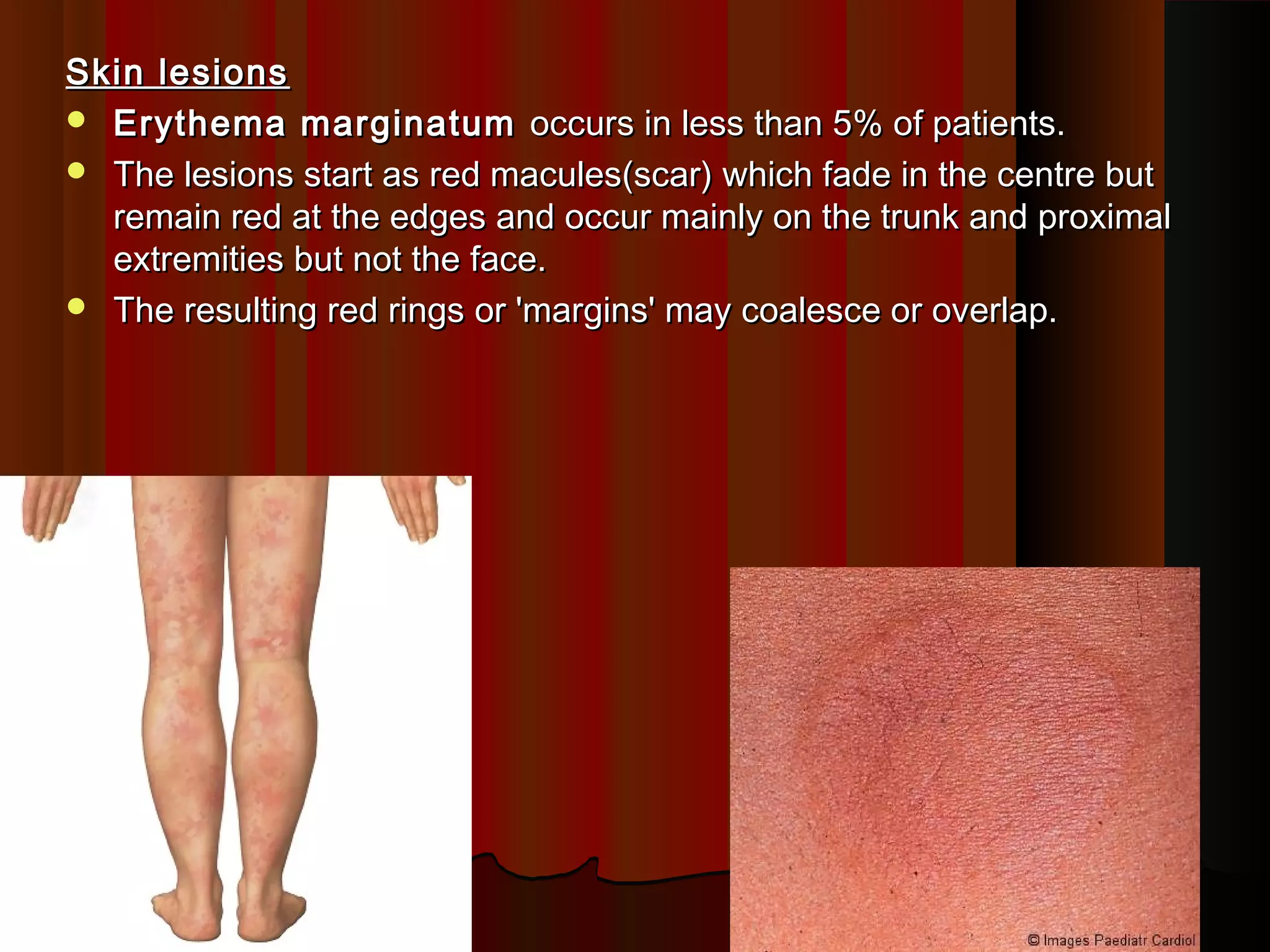5.Rheumatic heart disease pathology | PPT