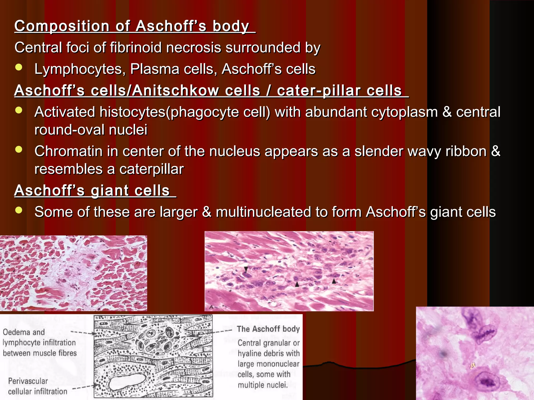 5.Rheumatic heart disease pathology | PPT