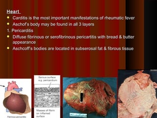 5.Rheumatic heart disease pathology | PPT
