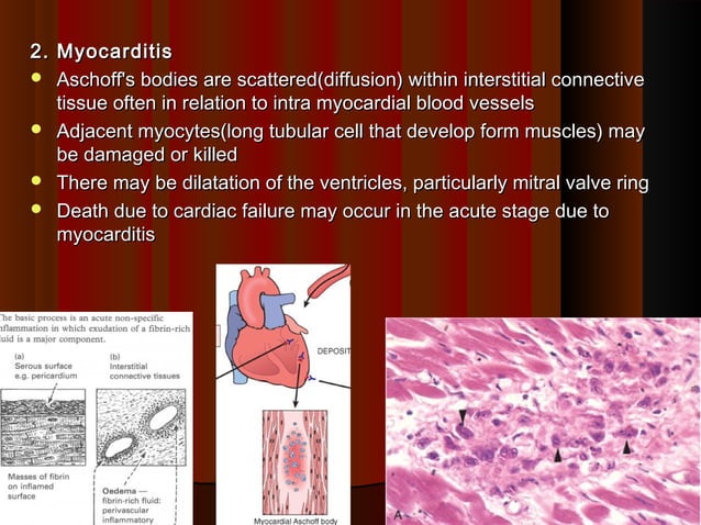 5.Rheumatic heart disease pathology | PPT
