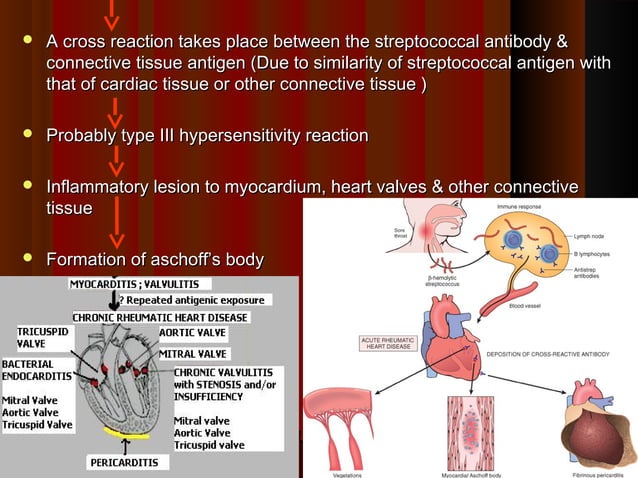 5.Rheumatic heart disease pathology | PPT
