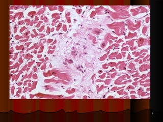 5.Rheumatic heart disease pathology | PPT
