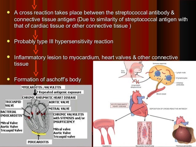Rheumatic Heart Disease Pathophysiology Schematic Diagram Pa
