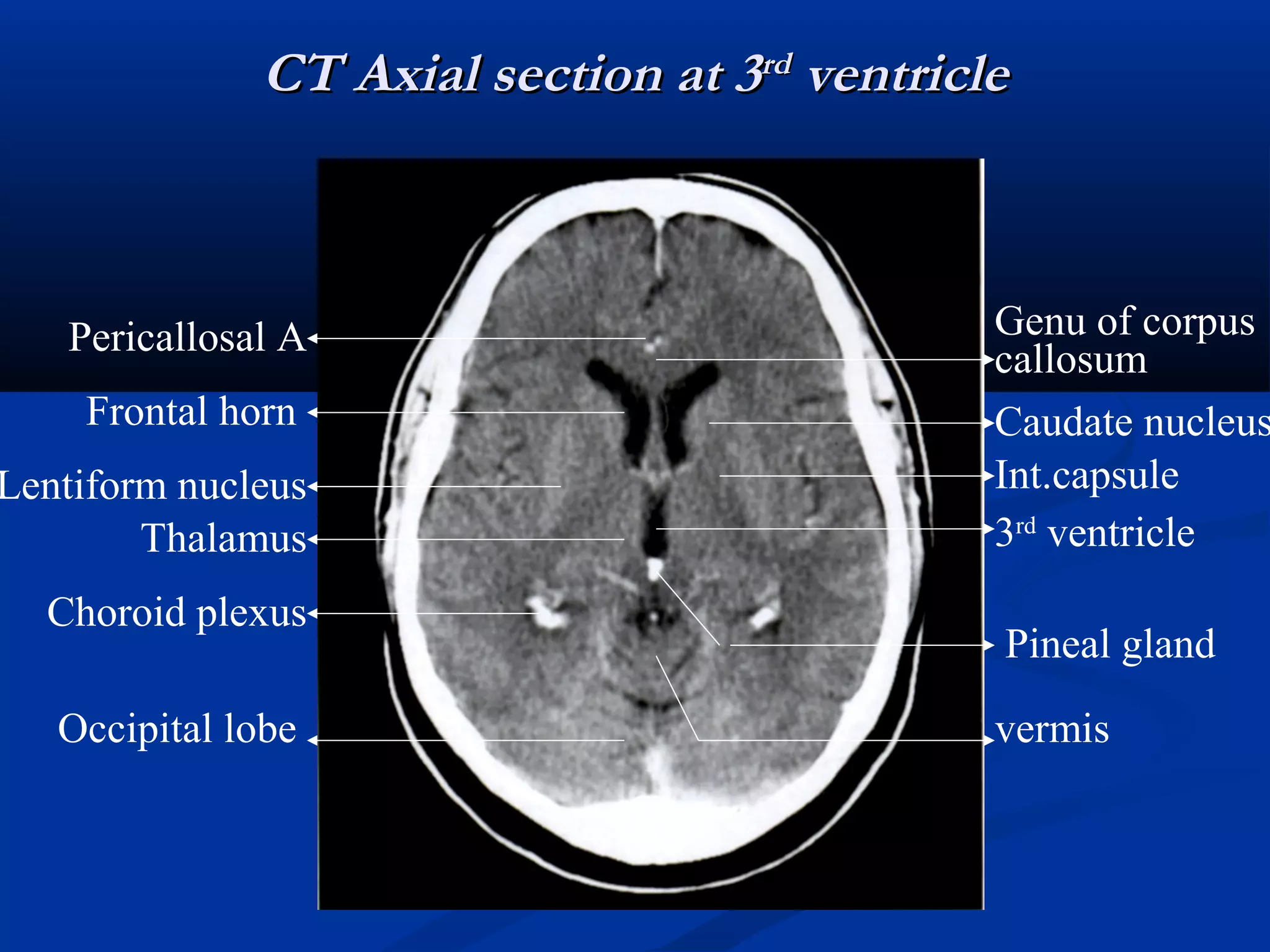 Radiological anatomy & Techniques of the Ventricular system | PPT