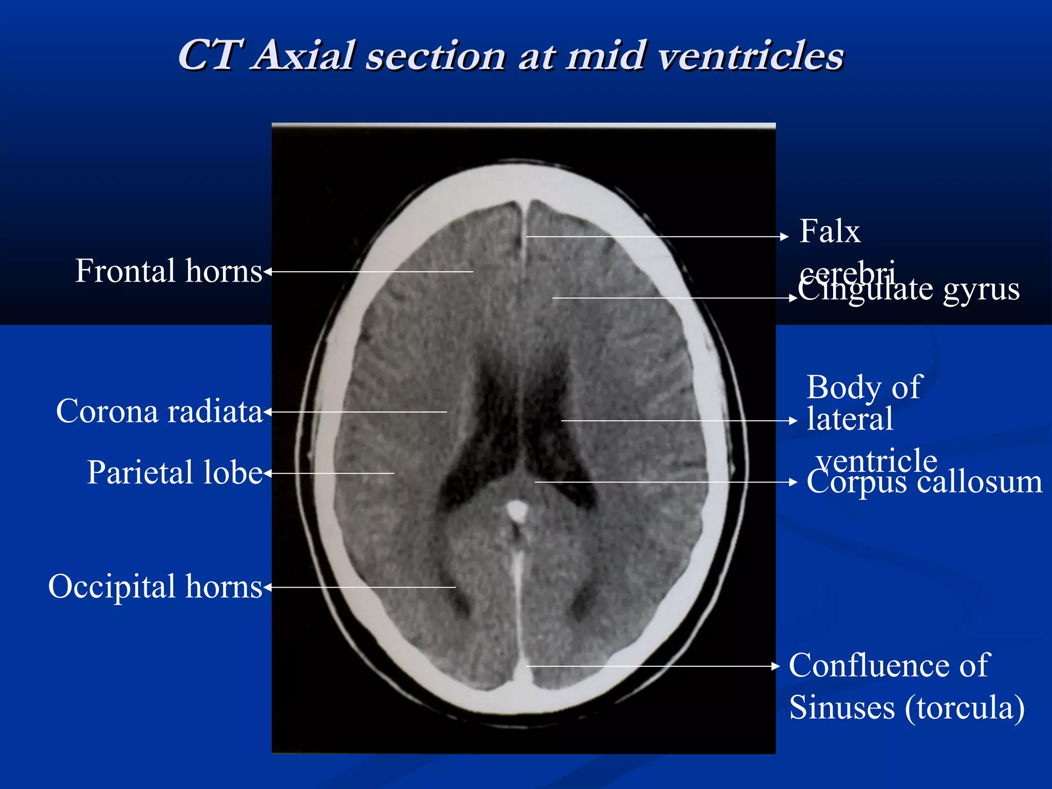 Radiological anatomy & Techniques of the Ventricular system | PPT