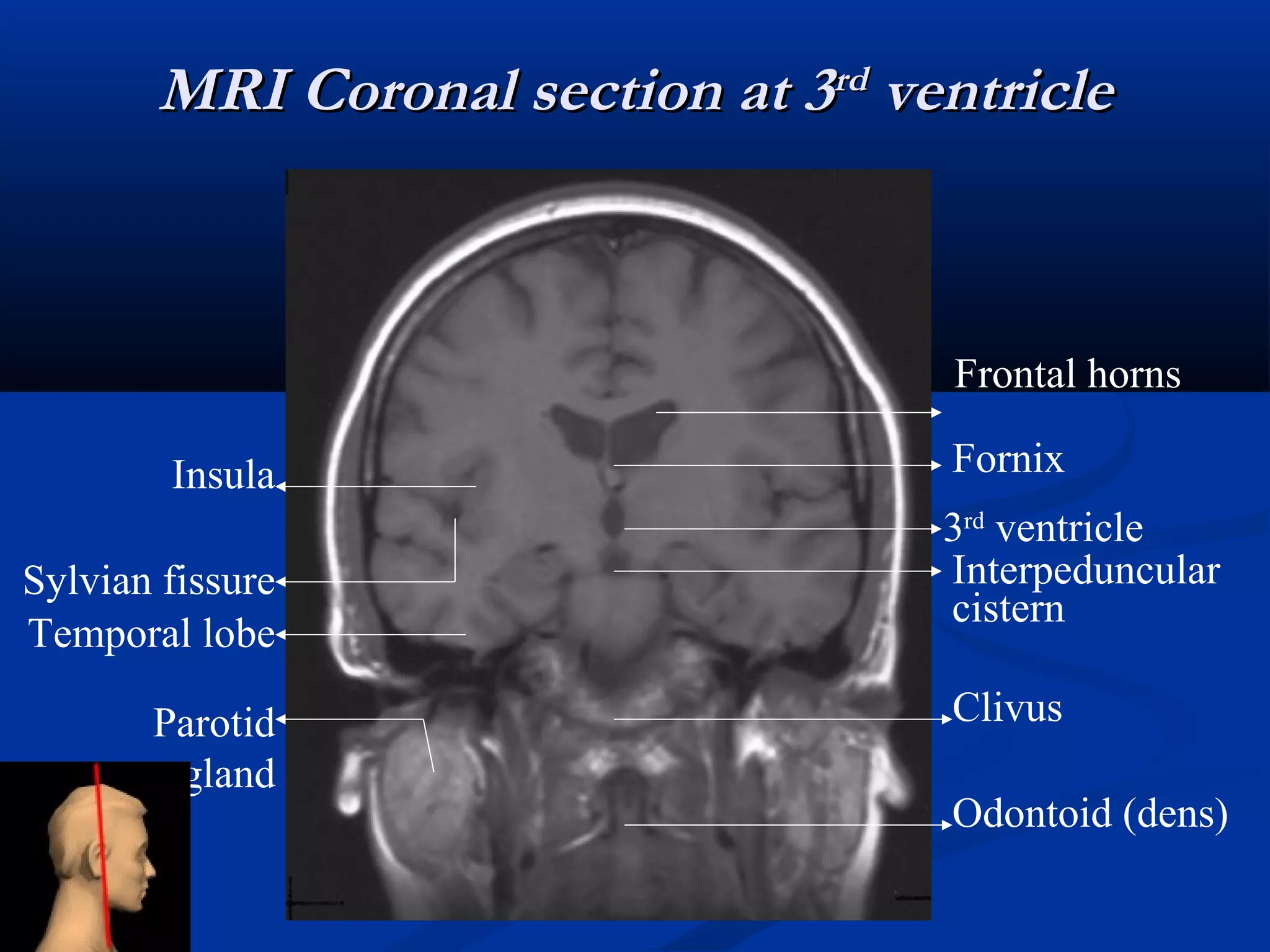 Radiological anatomy & Techniques of the Ventricular system | PPT