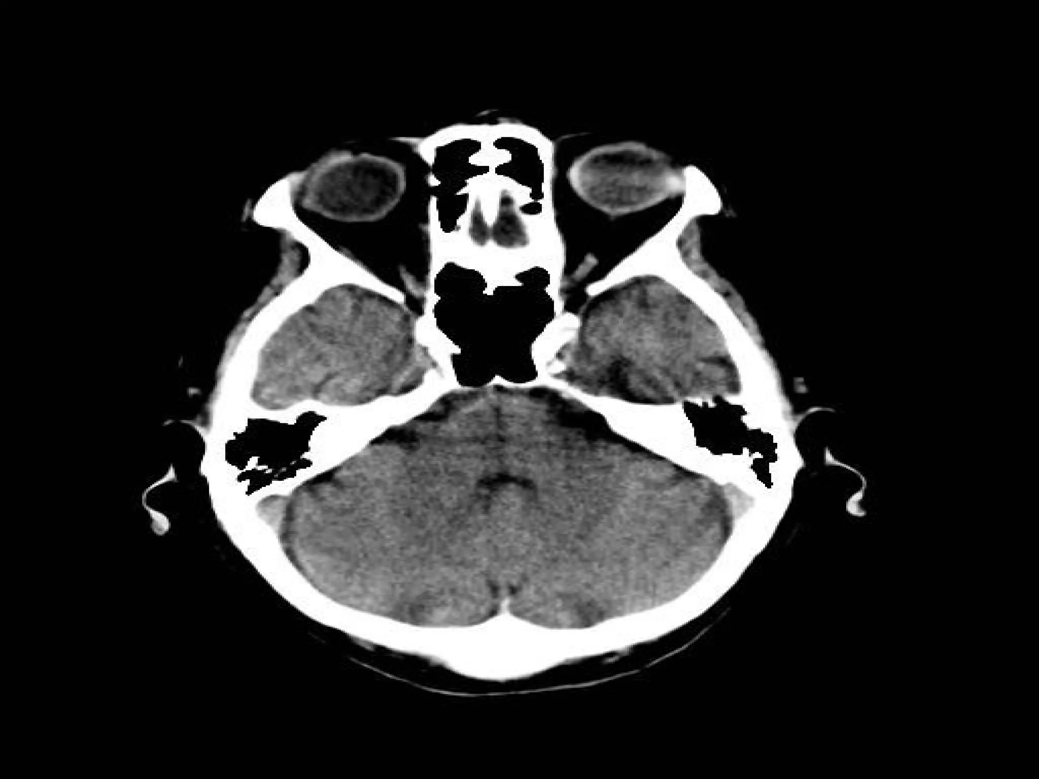 Radiological anatomy & Techniques of the Ventricular system | PPT