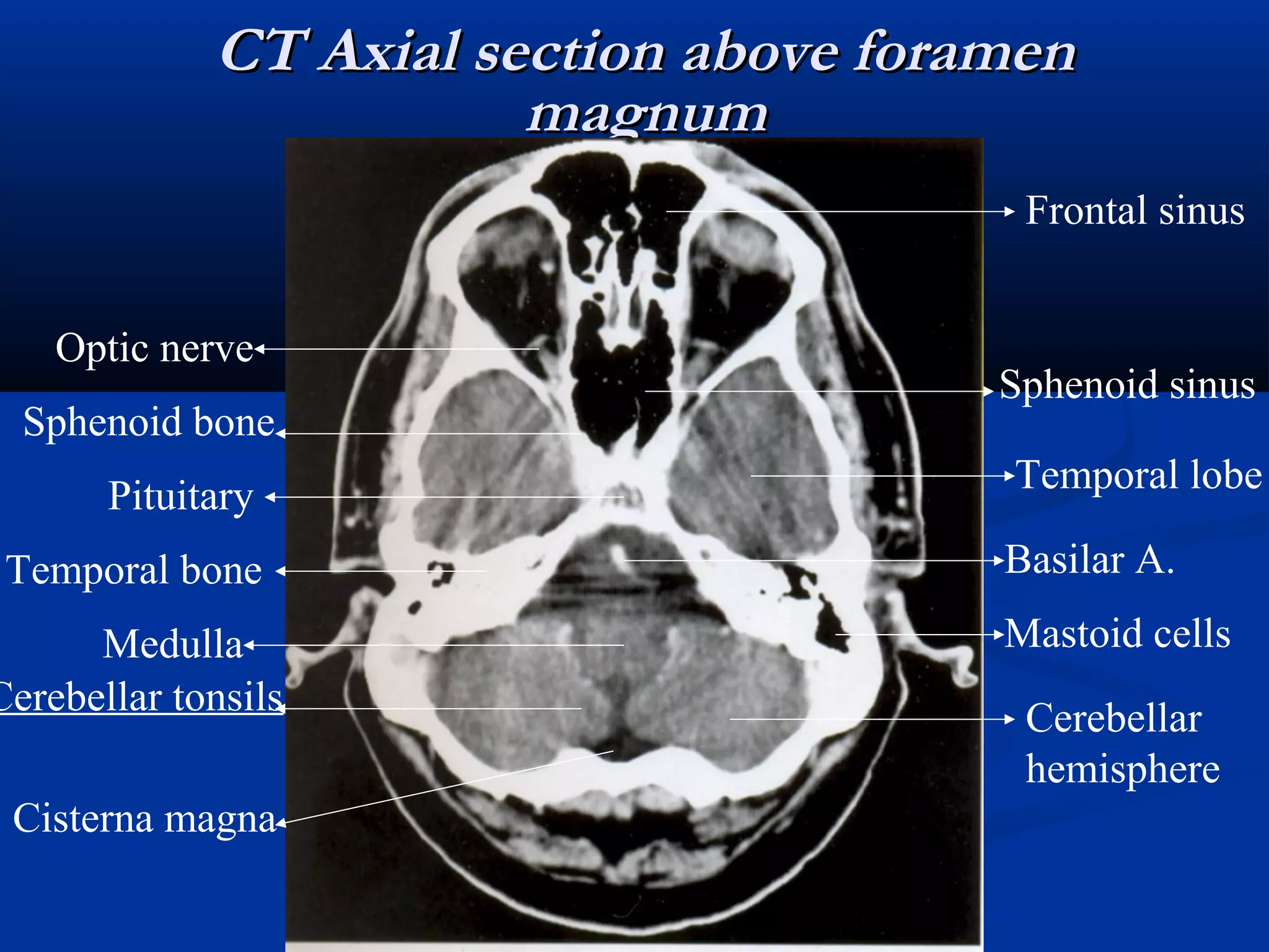 Radiological anatomy & Techniques of the Ventricular system | PPT