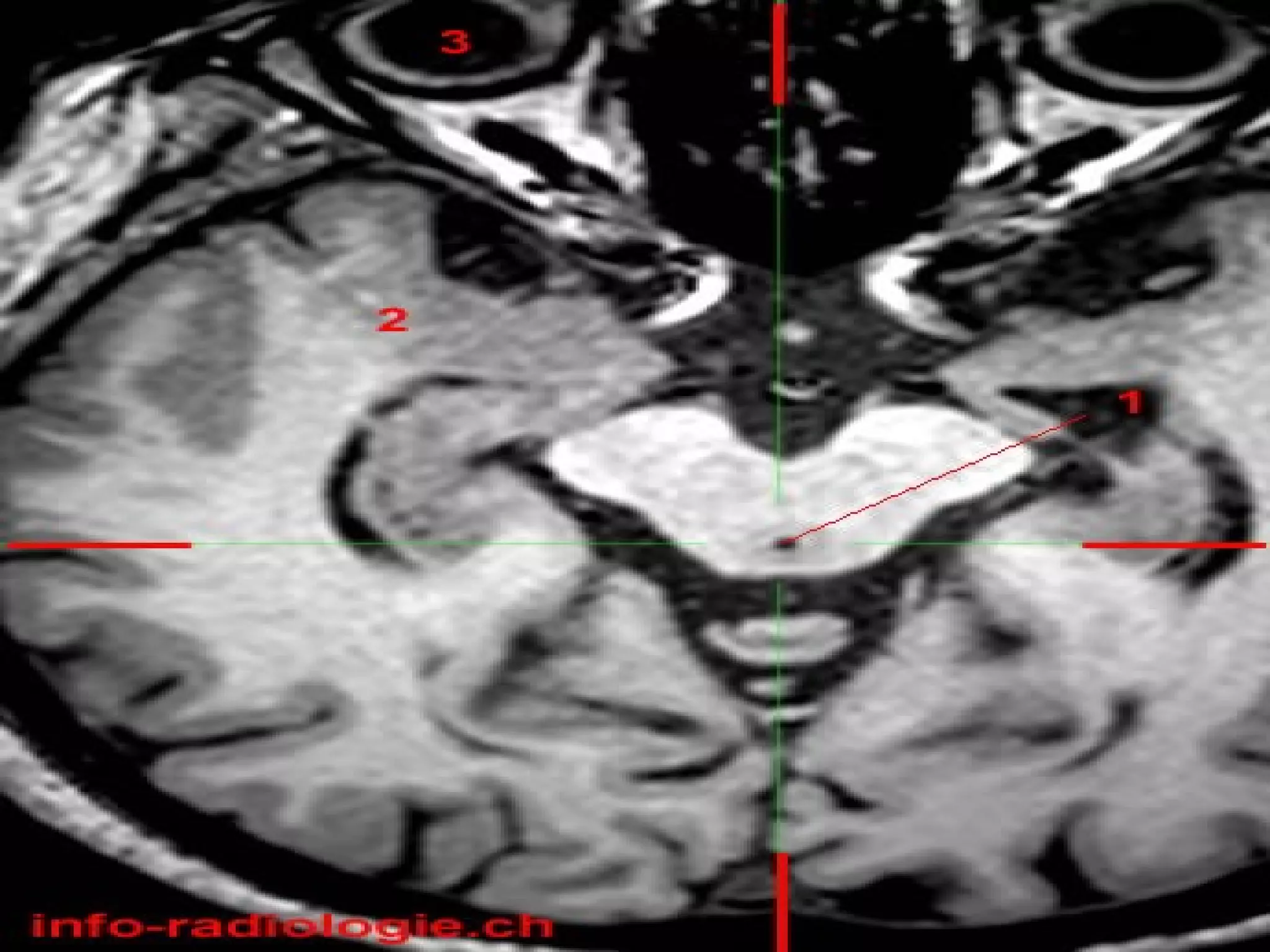 Radiological anatomy & Techniques of the Ventricular system | PPT