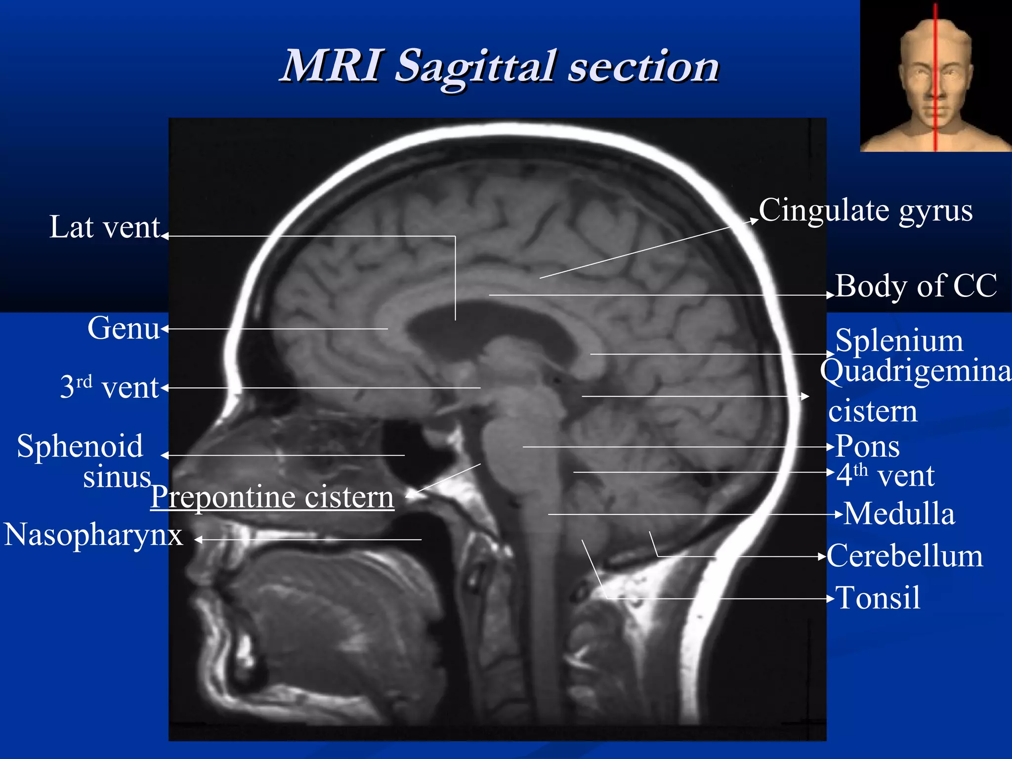Radiological anatomy & Techniques of the Ventricular system | PPT