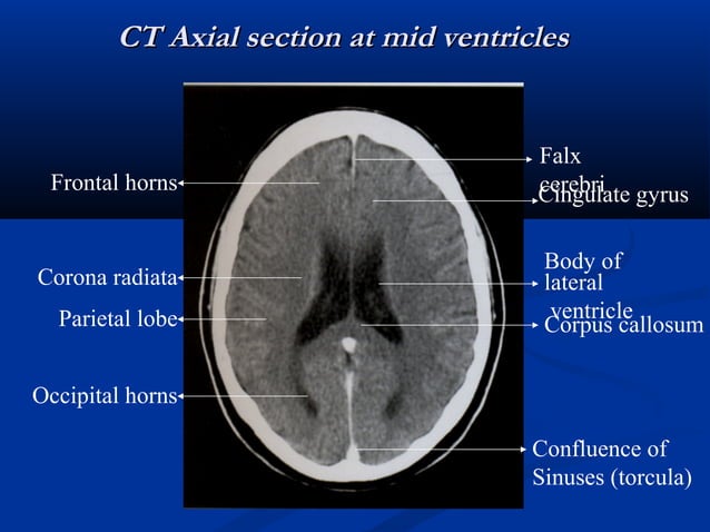 Radiological anatomy & Techniques of the Ventricular system | PPT | Brain and Nervous System ...