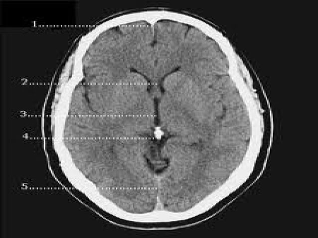 Radiological anatomy & Techniques of the Ventricular system | PPT | Brain and Nervous System ...