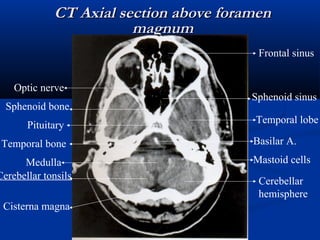 Radiological anatomy & Techniques of the Ventricular system | PPT