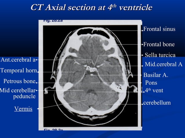 Radiological anatomy & Techniques of the Ventricular system | PPT | Brain and Nervous System ...