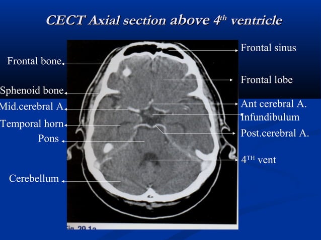 Radiological anatomy & Techniques of the Ventricular system | PPT | Brain and Nervous System ...