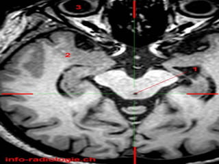 Radiological anatomy & Techniques of the Ventricular system | PPT