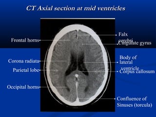 Radiological anatomy & Techniques of the Ventricular system | PPT