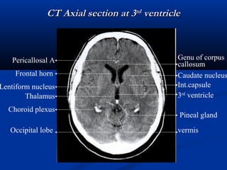 Surface Anatomy Of Trigone Of Ventricle