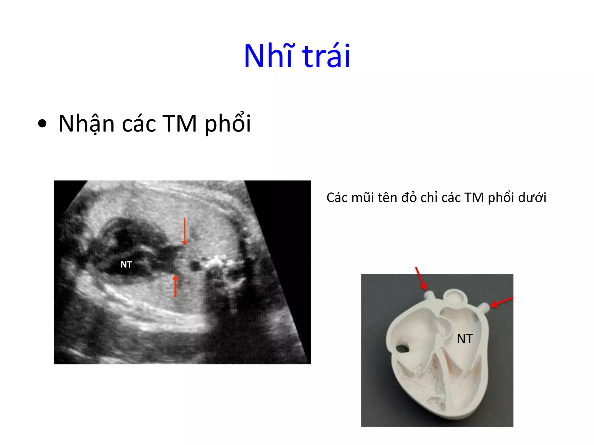 5. Sieu am tim thai binh thuong, GS Michel Collet | PDF