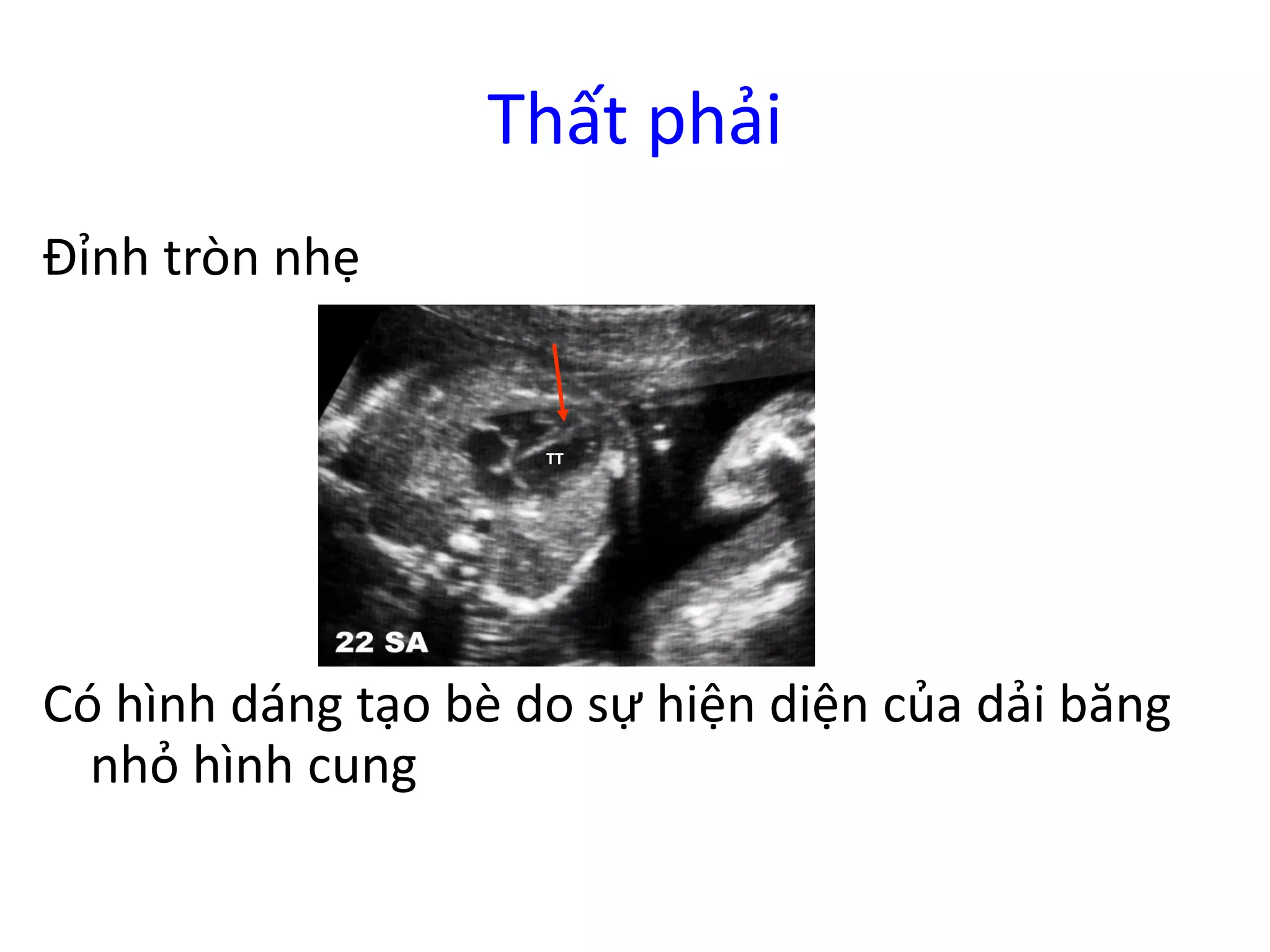 5. Sieu am tim thai binh thuong, GS Michel Collet | PDF