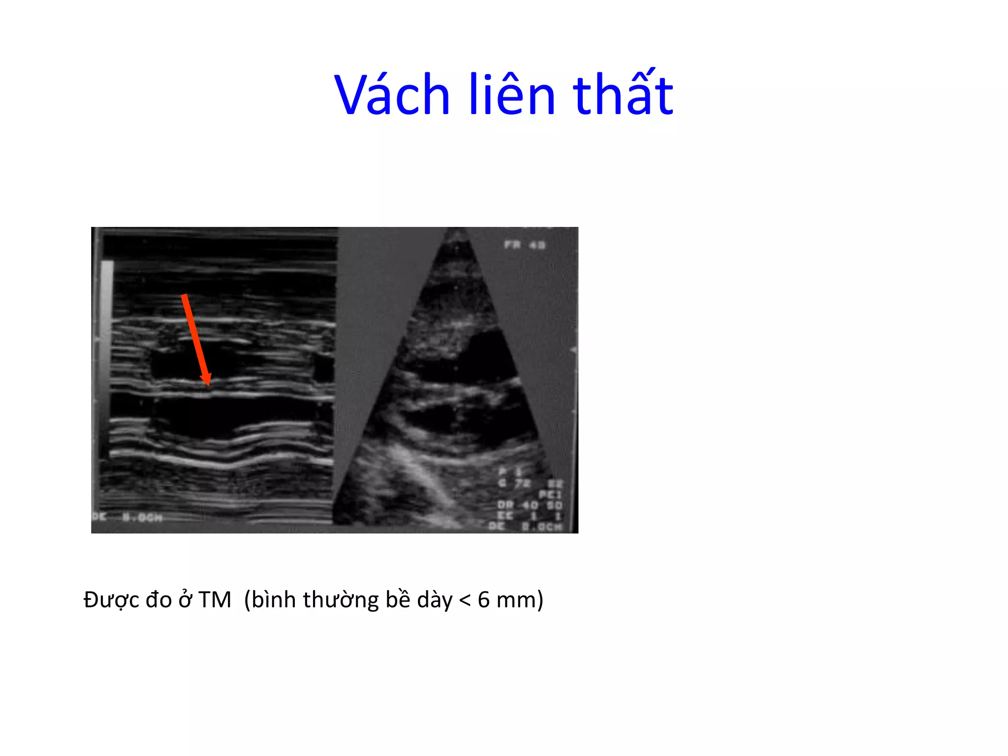 5. Sieu am tim thai binh thuong, GS Michel Collet | PDF